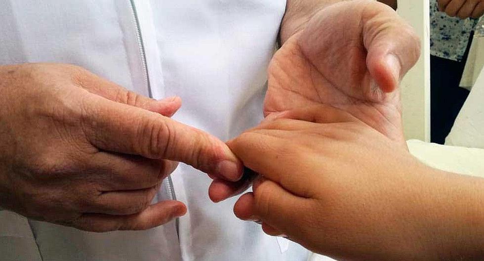 Minsa realizará 80 operaciones gratuitas a niños con malformaciones en ...