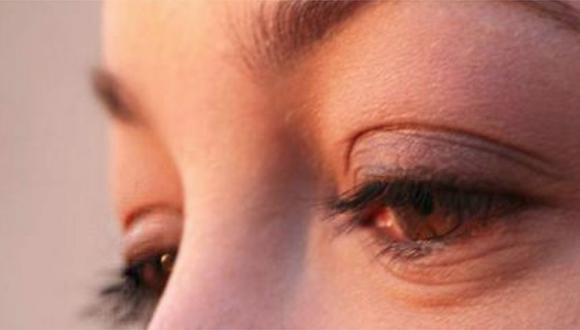 Factores ambientales pueden desencadenar carnosidades en los ojos ...