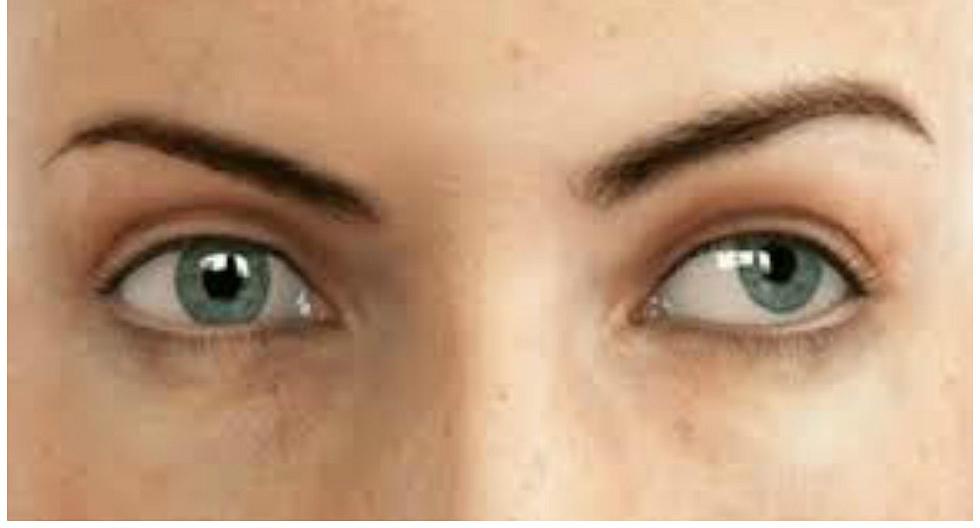 Estrabismo: Científicos detectan los factores genéticos que contribuyen ...